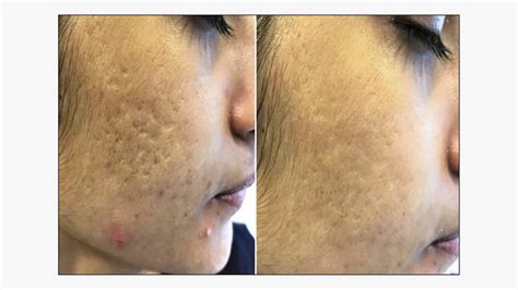 Subcision Acne Scars