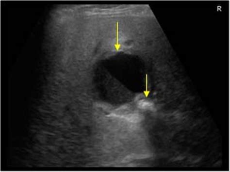 Abdomen And Retroperitoneum 1 2 Gallbladder And Bile Ducts Case 1 2 8 Gallbladder Abscess