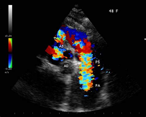 Color Doppler Imaging Showing The Pulmonary And Aortic Stenosis In