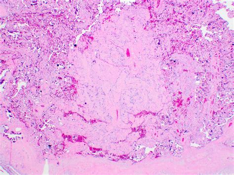 Pathology Outlines Infarct