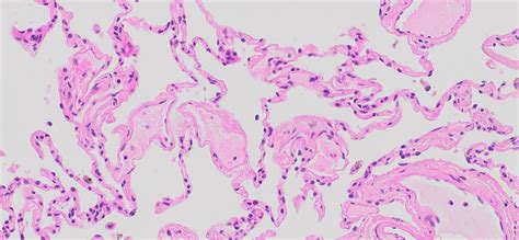 Emphysema Histology Vs Normal