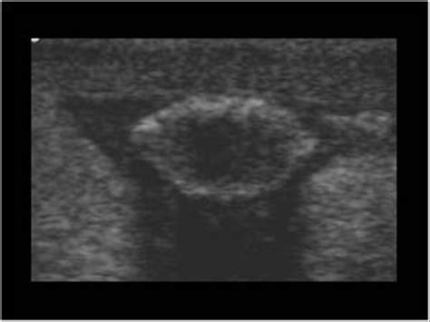 Pediatrics 9 3 Pediatric Scrotum Case 9 3 4 Neonatal Extravaginal Testicular Torsion And