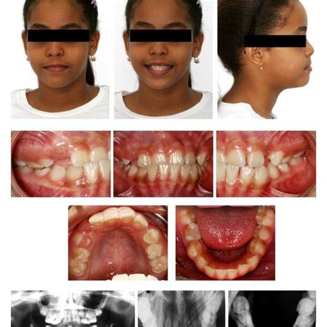 Pdf Diagnosis And Treatment Of Pseudo Class Iii Malocclusion