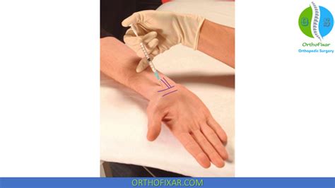 Carpal Tunnel Injection