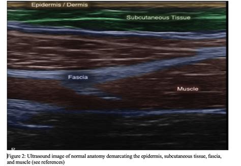 Ultrasound Diagnosis Of Necrotizing Soft Tissue Infections Core Em