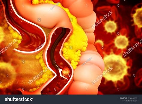 Colon Cancer Colonoscopy Colon Polyp Removal Stock Illustration