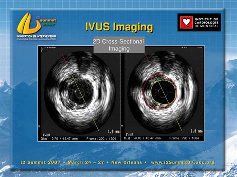 Ppt Navigating The Coronary Circulation Angiography Vs Ivus Pearls
