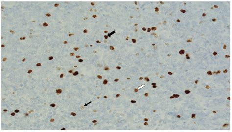 D Dimer In Oncology Marker Of Coagulation Malignancy And Metastasis