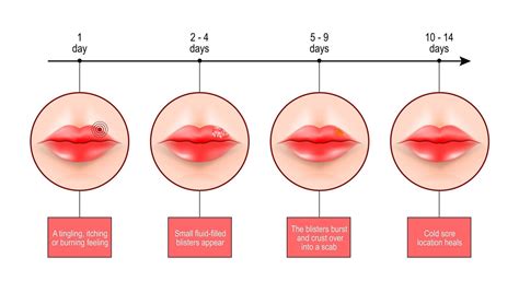 Herpes Lesion Healing