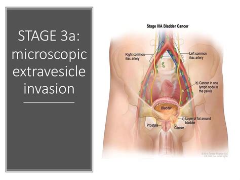 Urinary Bladder Carcinoma Pptx