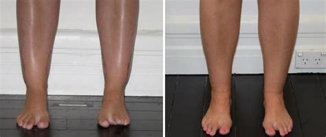 Calf Ankle Liposuction Sydney Gold Coast Canberra Adelaide
