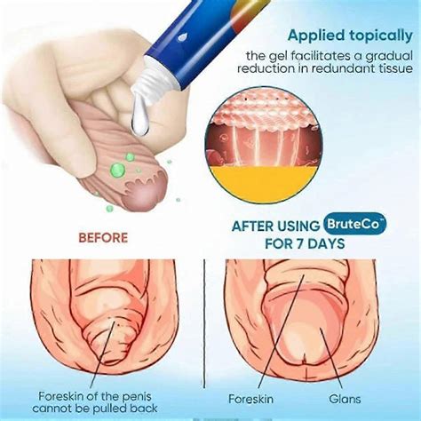 Redundant Foreskin Corrector Gel Natural Ingredients Phimosis Foreskin
