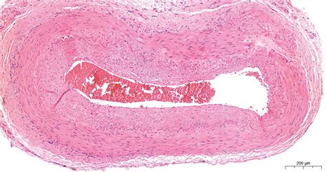Histological Interpretation Of Temporal Artery Biopsies Diagnostic Histopathology