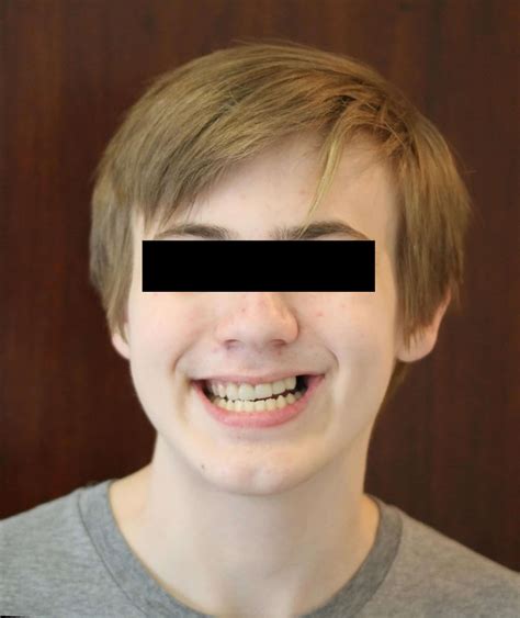 Congenital Growth Defect And Missing Teeth Dentistry Today