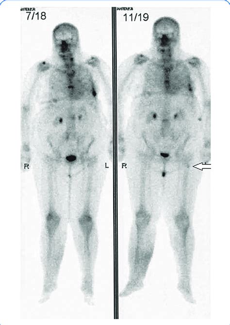 The Three Phase Bone Scintigraphy Obtained After Eleven Doses Of