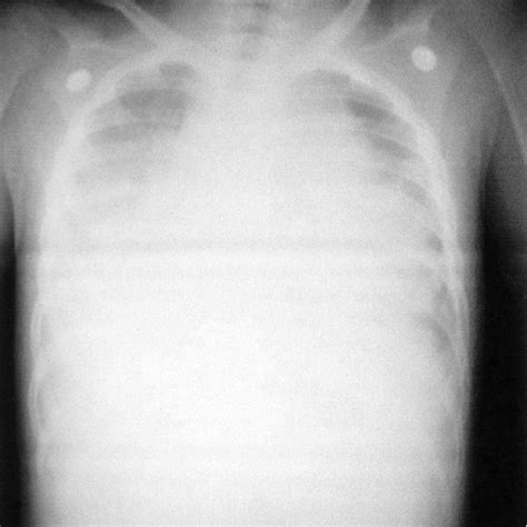 Pdf Purulent Pericarditis Caused By Group A Streptococcus