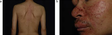 Drug Eruptions Great Imitators Clinics In Dermatology