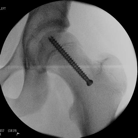 Radiopaedia Case Slipped Upper Femoral Epiphysis Pre Slip Id 22124