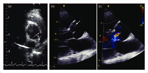 Transthoracic Echocardiogram Showing A Type A Aortic Dissection A B Download Scientific
