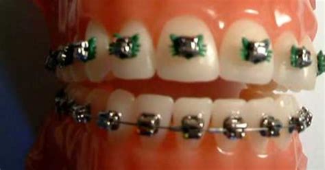 Hello Kitty Braces Designs