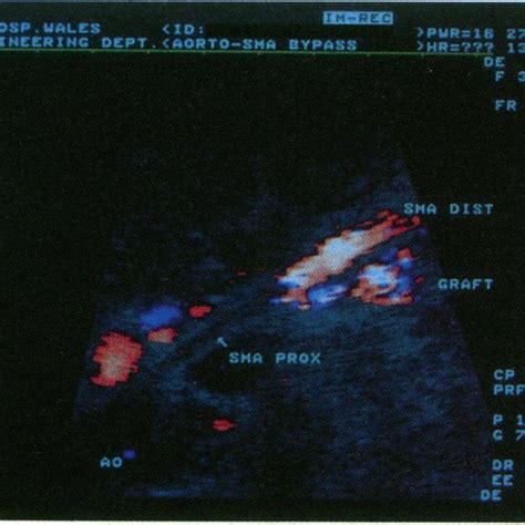 Duplex Colour Flow Scan Showing Sma Stenosis 90 Figure 4 Duplex Download Scientific