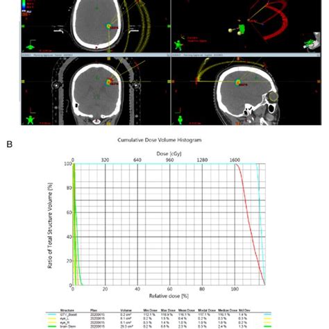 A Isodose Line Covering The Tumor For Radiosurgery Performed With The