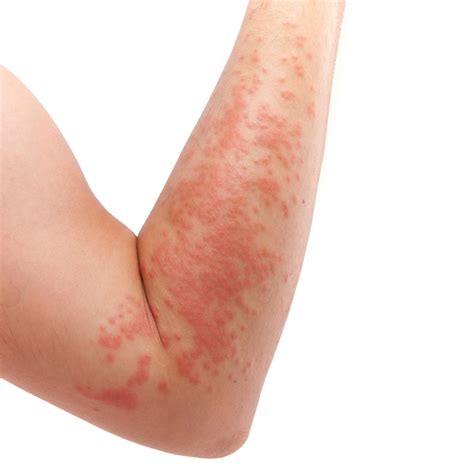 Meningitis Rash On Arm