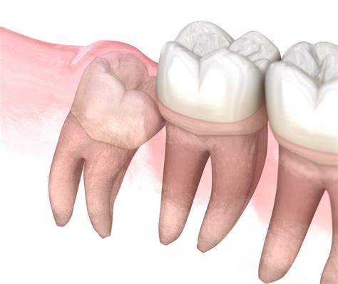Tooth Impaction Guide Types Symptoms And Treatment Options