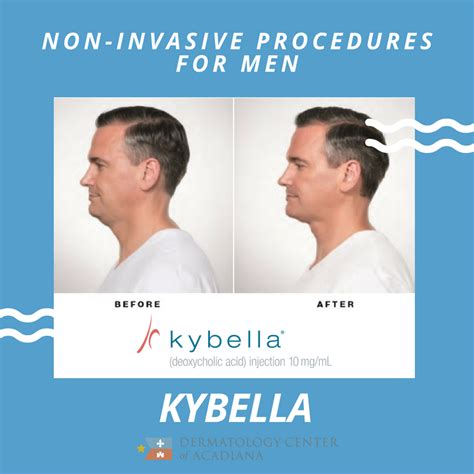 Double Chins And Neck Fat Are No Match For Kybella A Series Of