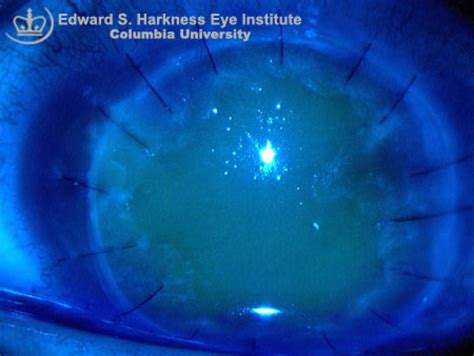 Epithelial Defect Vagelos College Of Physicians And Surgeons