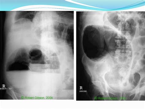 Ppt Bowel Obstruction Powerpoint Presentation Free Download Id2692522
