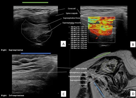 超声和剪切波弹性成像评估肩袖质量的有效性 european radiology x mol
