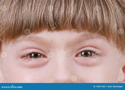 Allergic Conjunctivitis Discharge