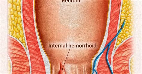 Hemorrhoids Symptoms Causes Treatments And Natural Approaches 2024