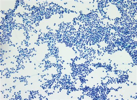 Fatures Of Aspiration Cytology Of Knee Joint Synovial Fluid Sf Of