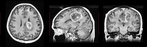 Preoperative Mri Showing A High Grade Cingulate Gyrus Glioma On The