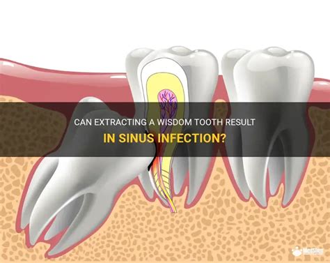Can Extracting A Wisdom Tooth Result In Sinus Infection Medshun