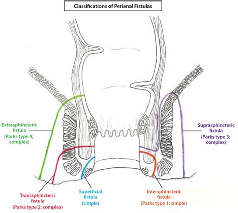 Anorectal Fistula Classification