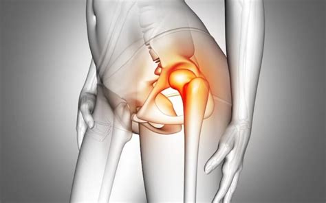 Tuberosidade Isquiática Causas E Tratamento