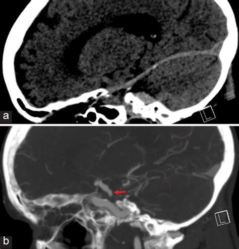 Surgical Neurology International
