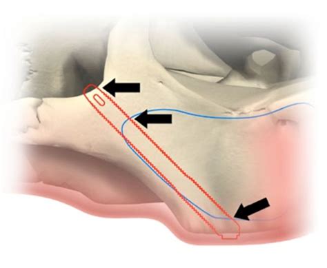 Zygomatic Implants Pocket Dentistry