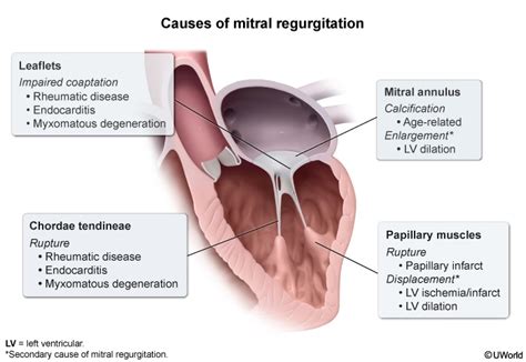 Valve Disorders Mitral Regurgitation Cardiology Uworld Medical Library