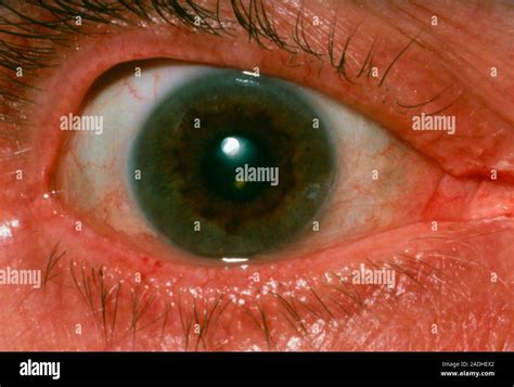 Kayser Fleischer Ring A Brownish Ring Overlying The Outer Rim Of The