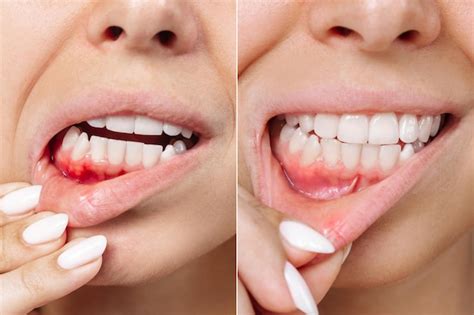 Premium Photo Young Woman With Red Bleeding Gums And Health Gums