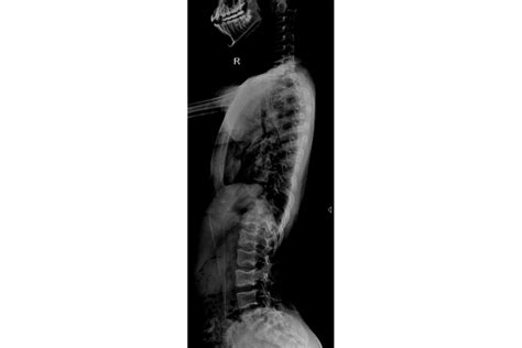 胸椎曲度变直怎么办？可以如何改善？5个经典动作推荐腾讯新闻