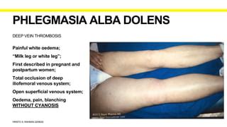 Plegmasia Alba And Cerulea Dolens Pptx
