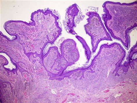 Epidermal Nevus Histology