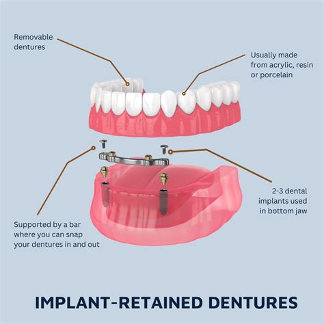 Every Type Of Implant Imaginable Costs And Finance Package