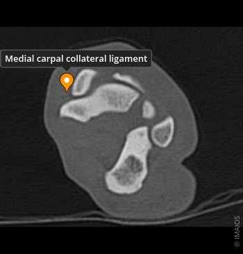 Medial Carpal Collateral Ligament Vet Anatomy Imaios