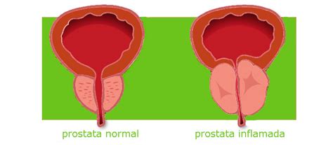 Dprostata Dp Prostatitis
